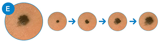 Mole Examination + Skin Cancer Screening - The Pearl Dermatology
